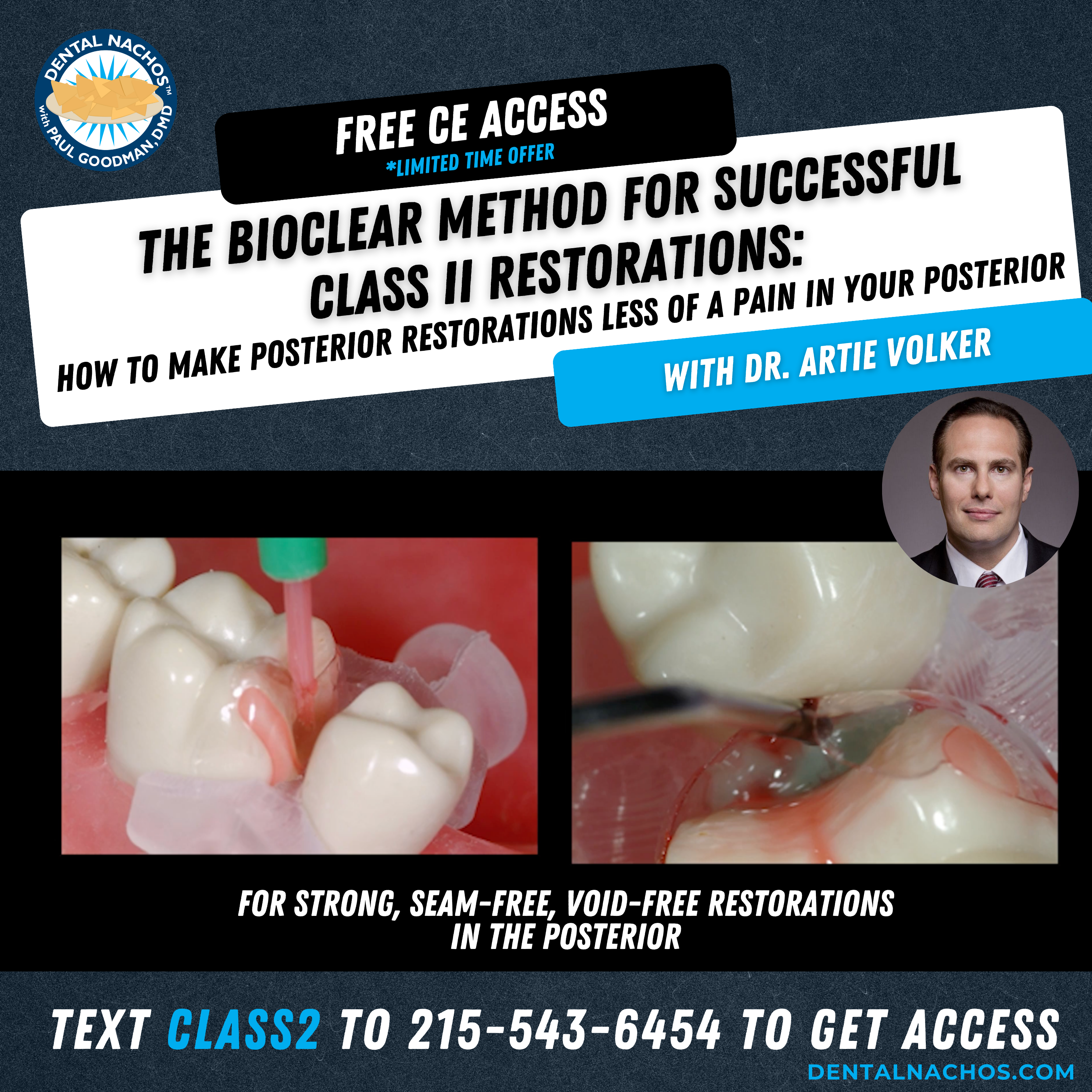The Bioclear Method for Successful Class II Restorations: “How to Make ...